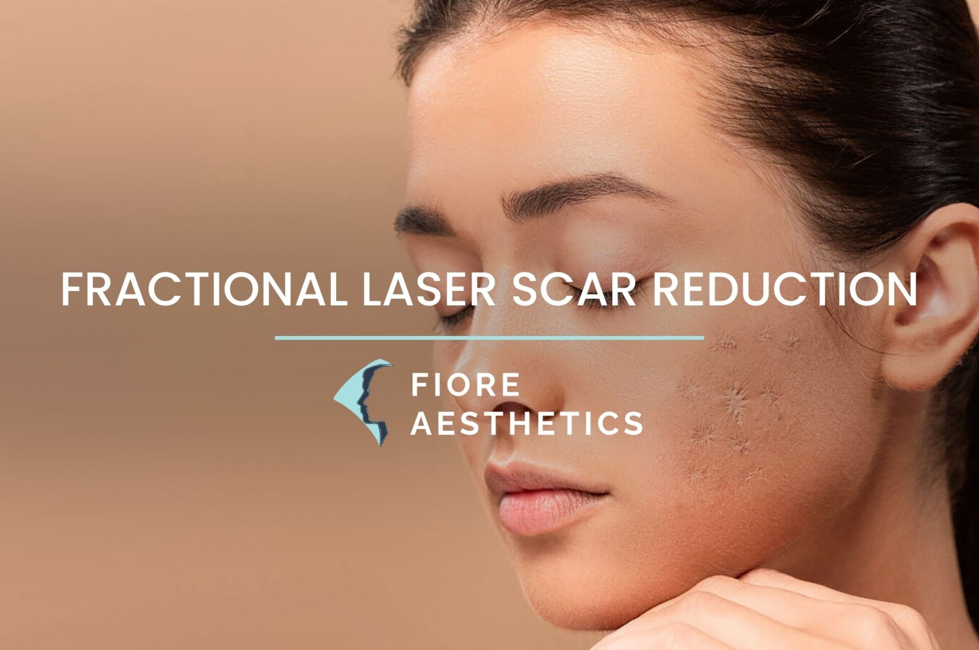 Scar Reduction | Fractional Laser Treatment | London
